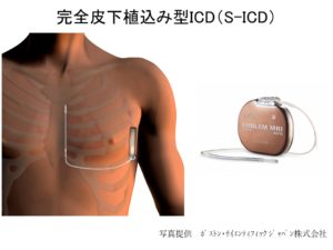 S-ICD - 心臓血管センター